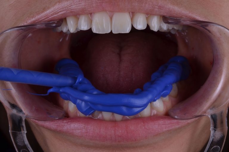 How to take a dental impression - FAQs | Zhermack