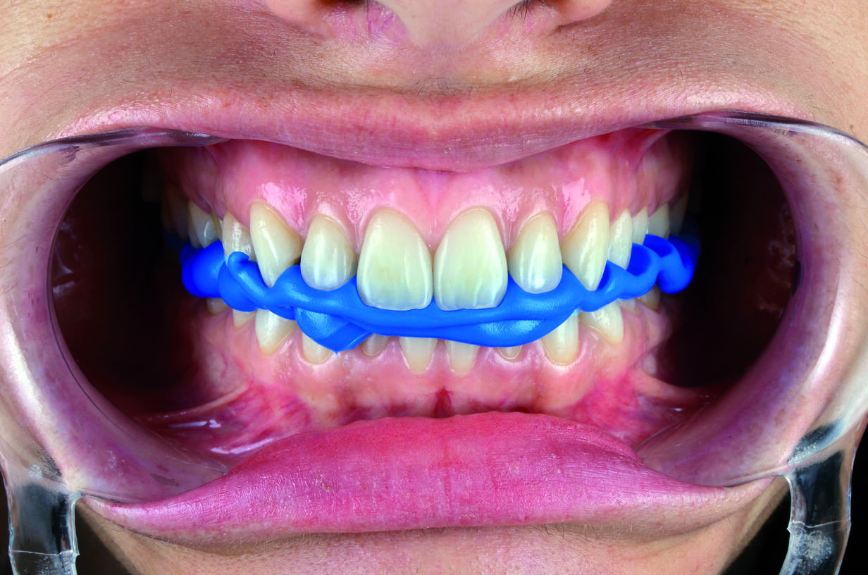 How to take a dental impression - FAQs | Zhermack